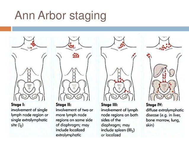 Hodgkin’s lymphoma
