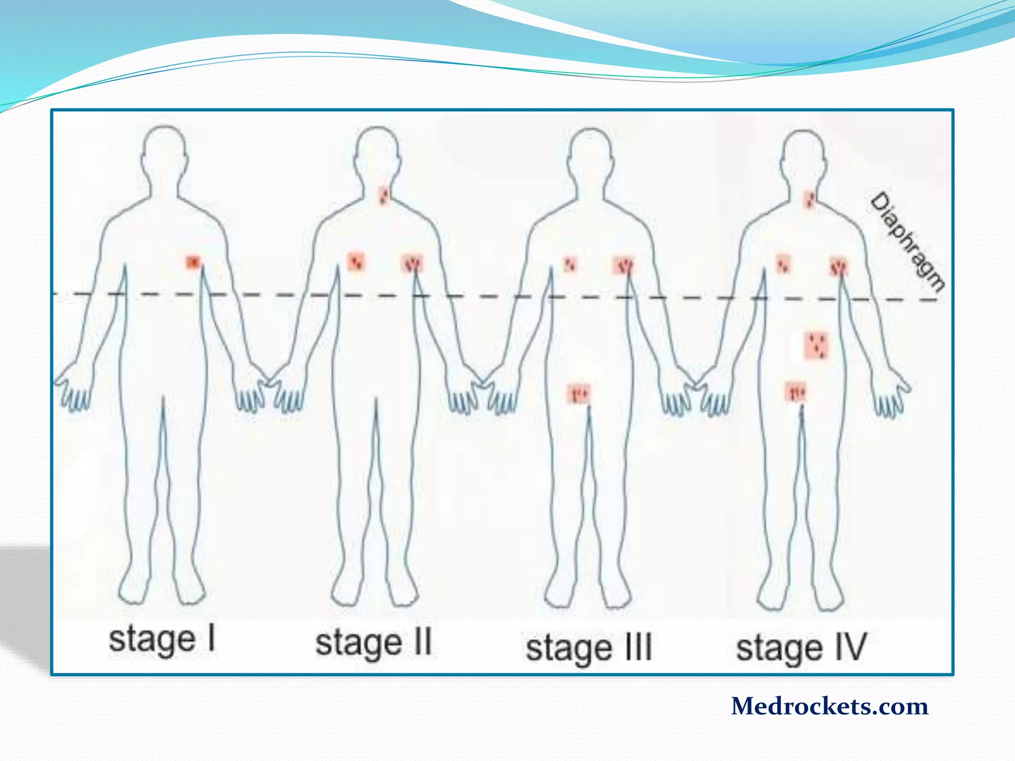 Hodgkin's lymphoma | PPTX