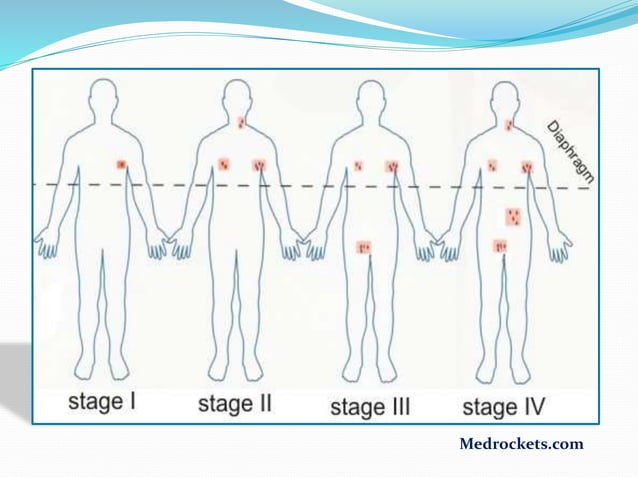Hodgkin's lymphoma | PPTX