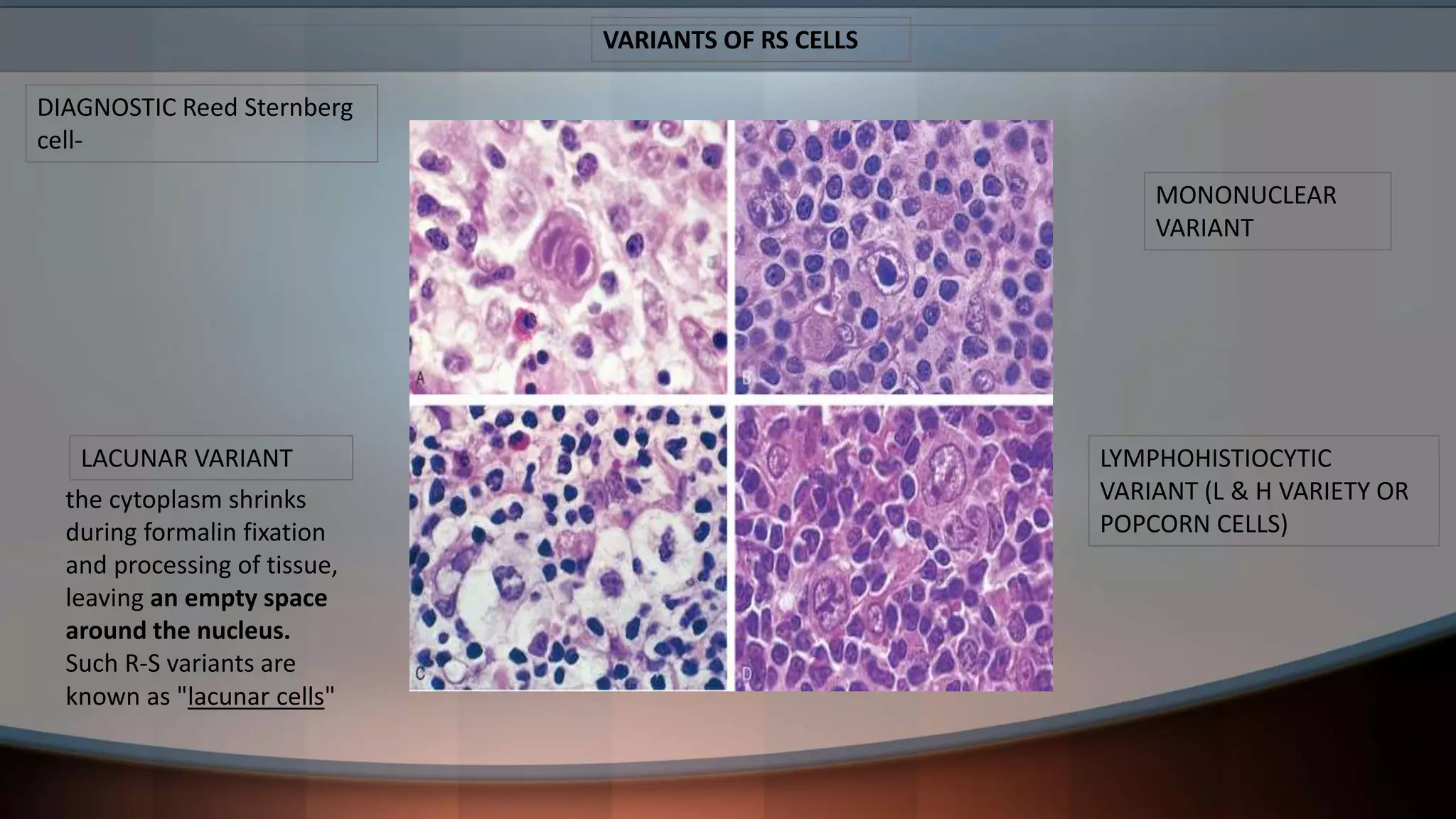 Hodgkins lymphoma | PPTX