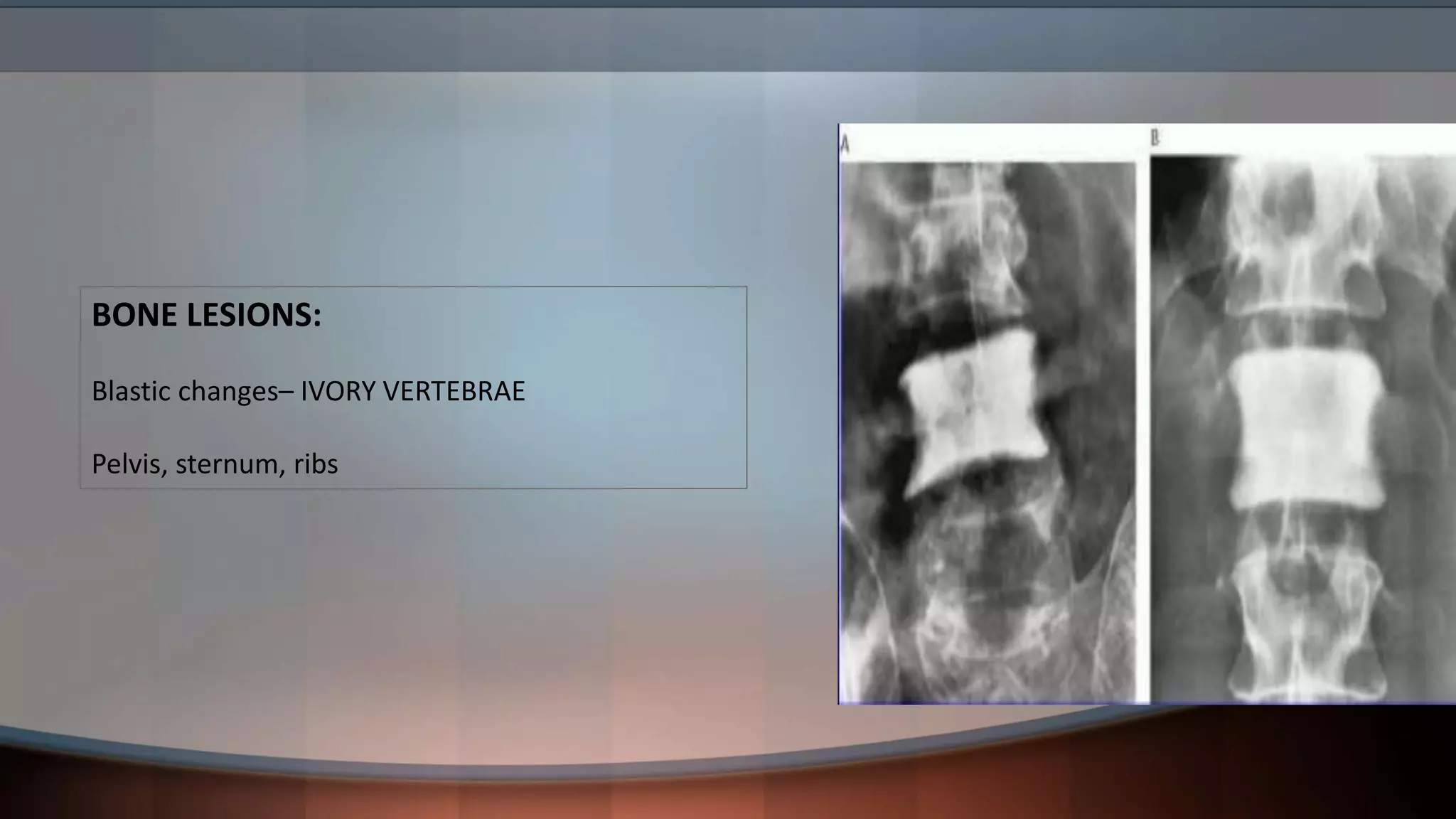 Hodgkins lymphoma | PPTX