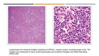 Hodgkin's lymphoma | PPTX