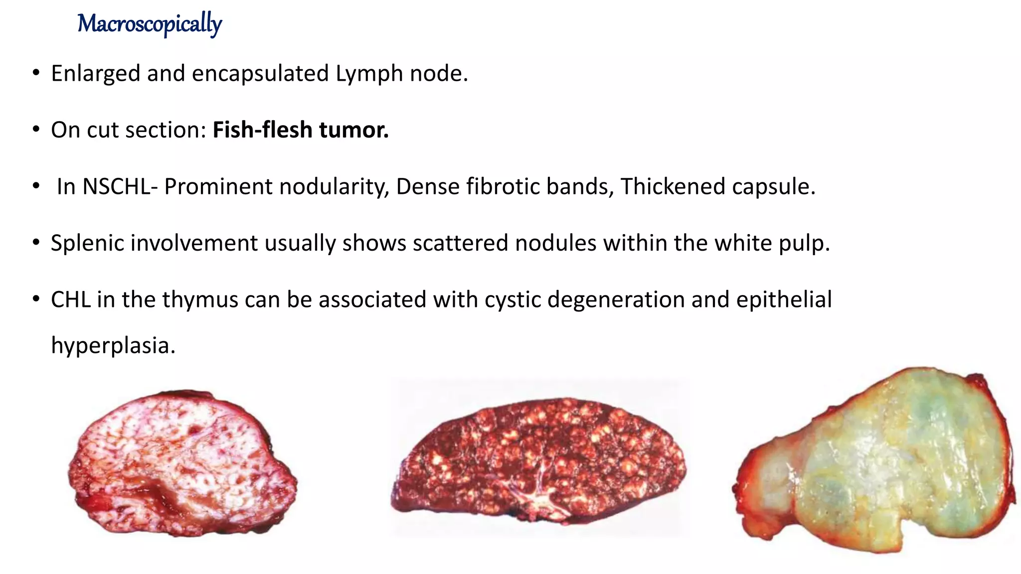 HODGKIN’S LYMPHOMA.pptx
