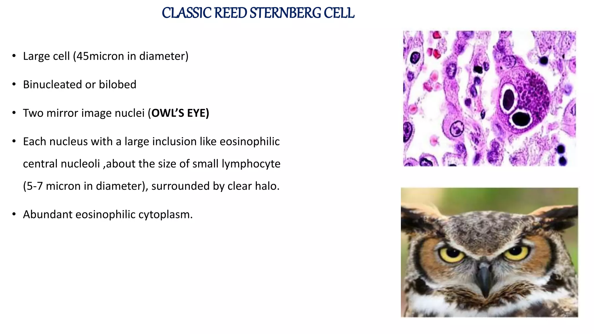 HODGKIN’S LYMPHOMA.pptx
