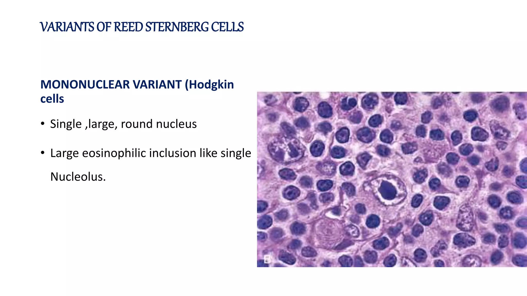 HODGKIN’S LYMPHOMA.pptx