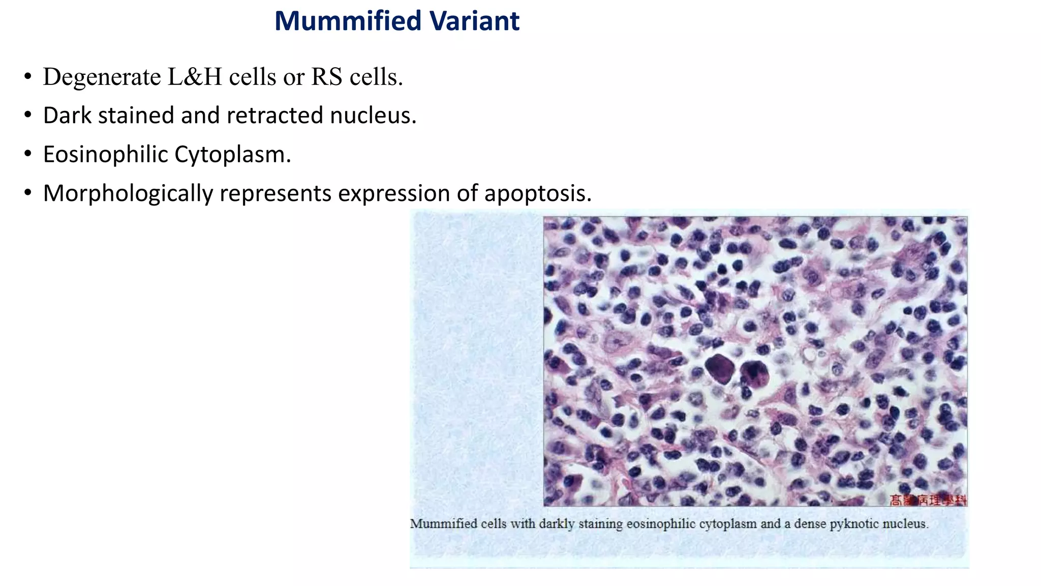 HODGKIN’S LYMPHOMA.pptx