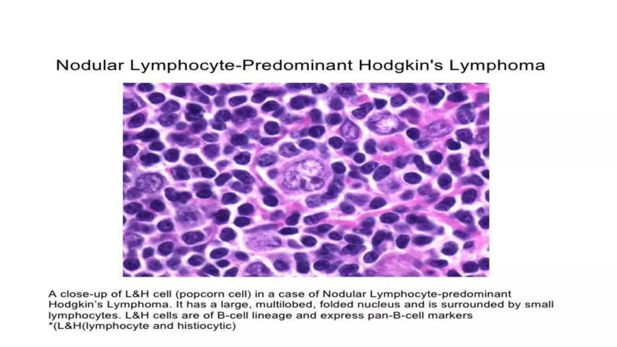 HODGKIN’S LYMPHOMA.pptx