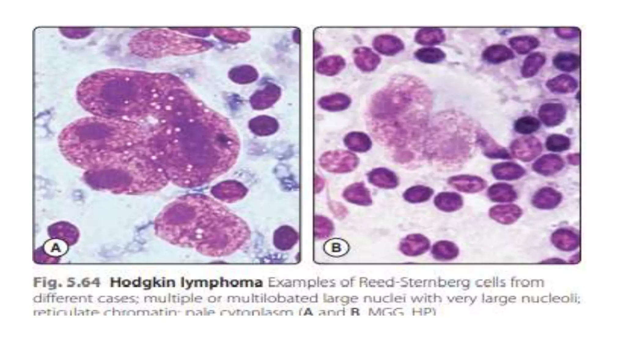 HODGKIN’S LYMPHOMA.pptx