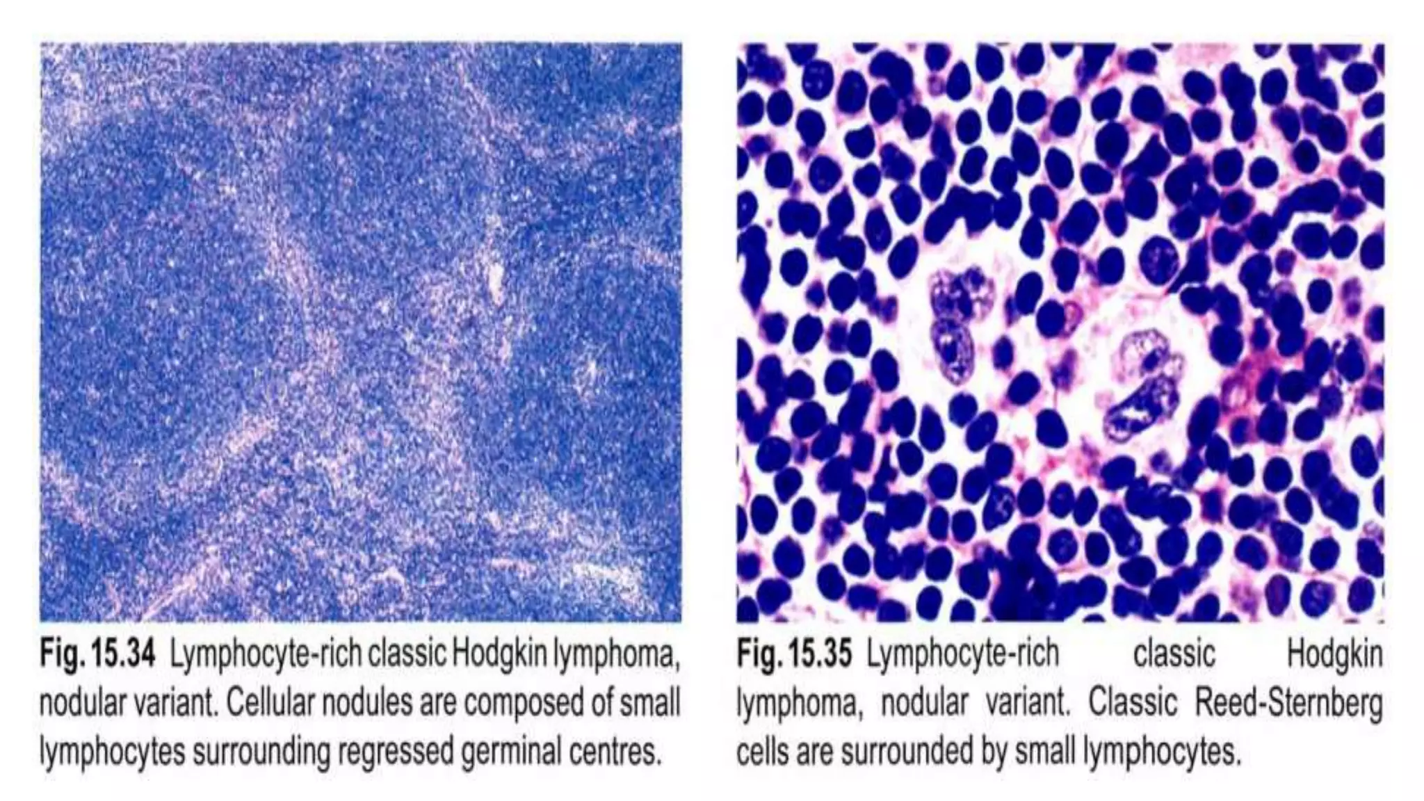 HODGKIN’S LYMPHOMA.pptx