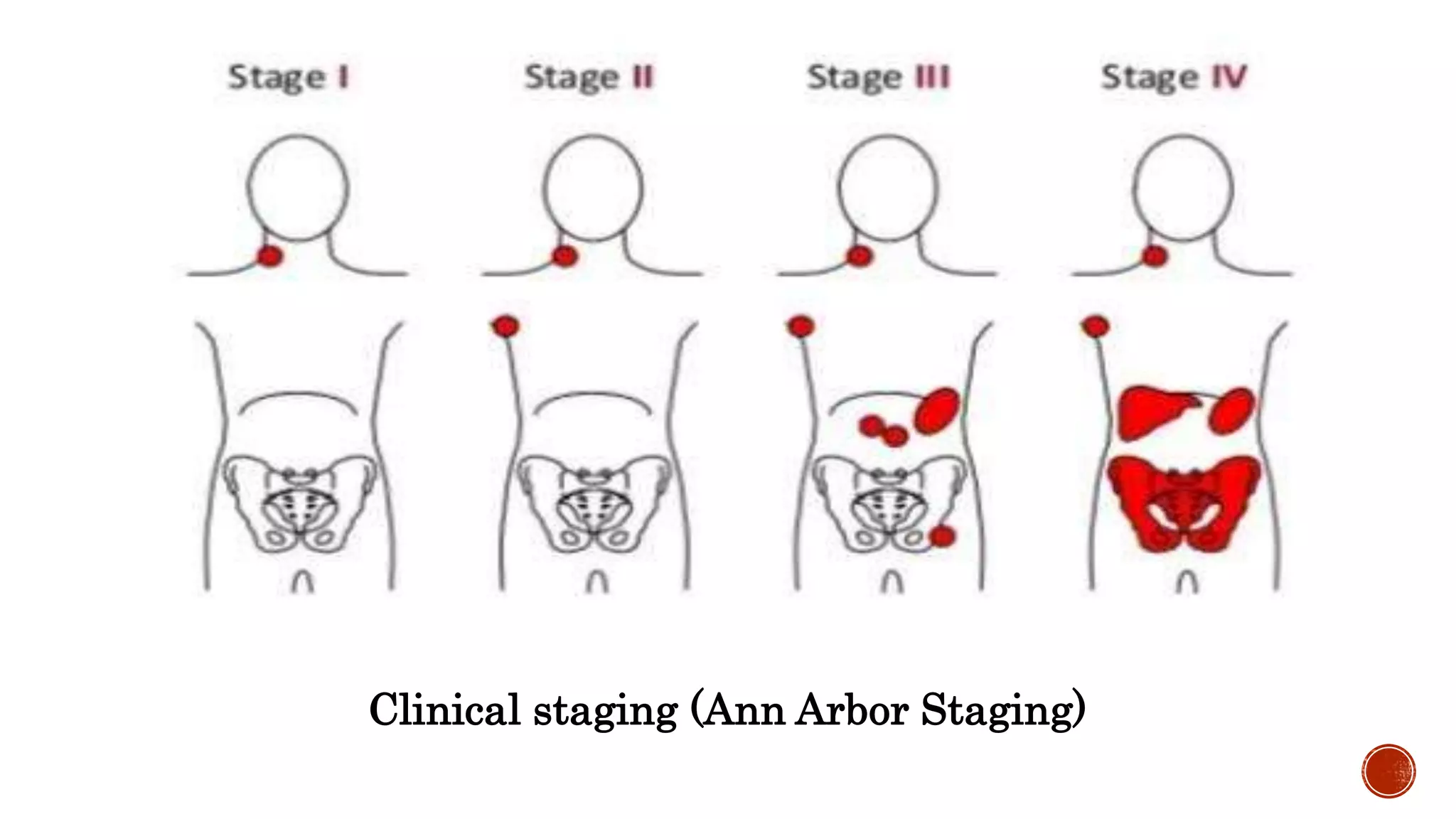 hodgkin's lymphoma.pptx