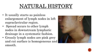 hodgkin's lymphoma.pptx