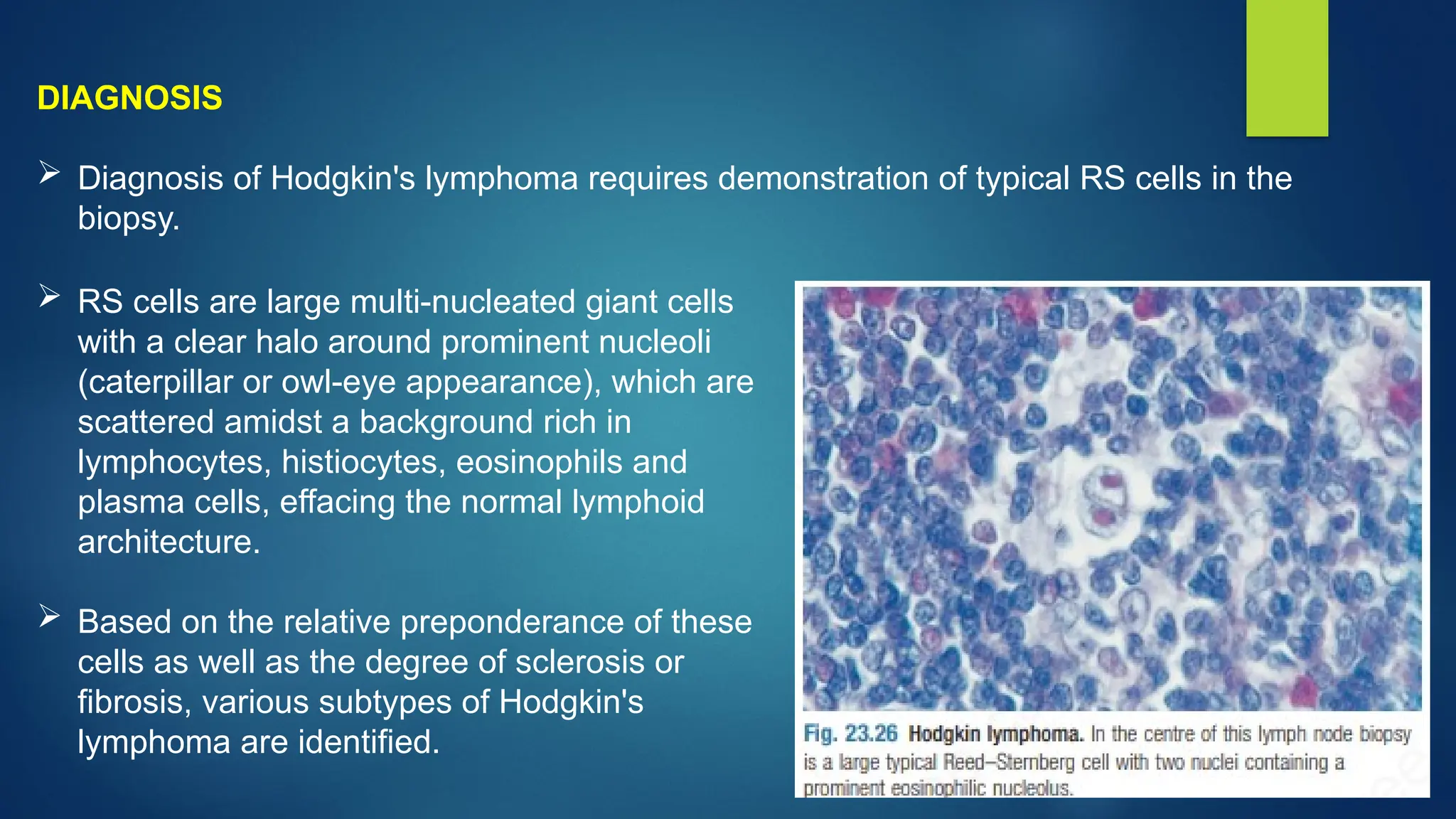 Hodgkins Lymphoma pptx for medical students. | PPTX