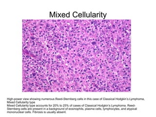 hodgkinslymphoma MEDICAL POWER POINT .pptx.pptx