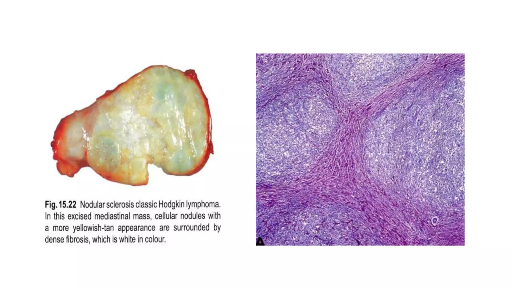 Hodgkins lymphoma ppt.pptx