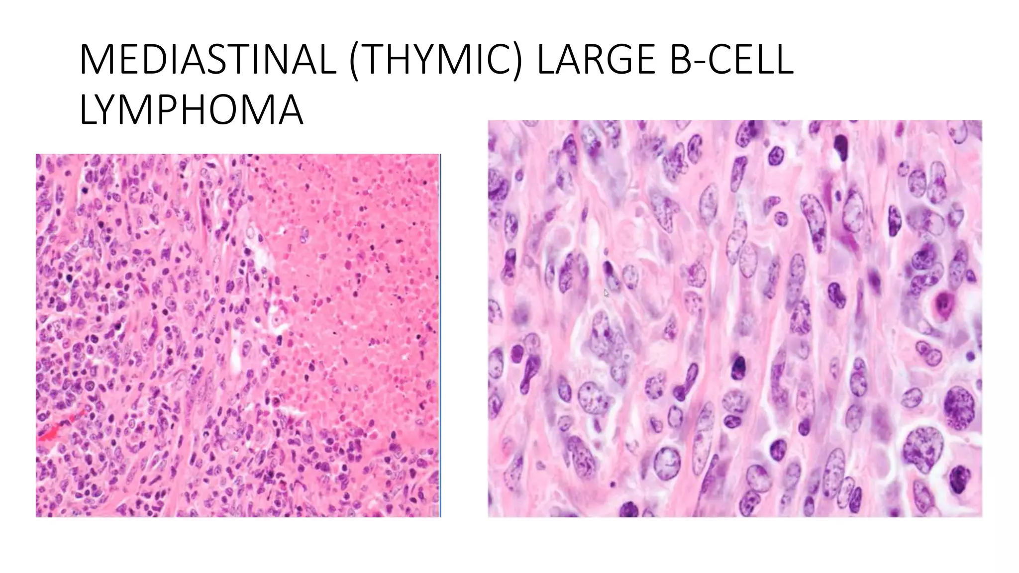 Hodgkins lymphoma ppt.pptx