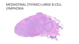 Hodgkins lymphoma ppt.pptx