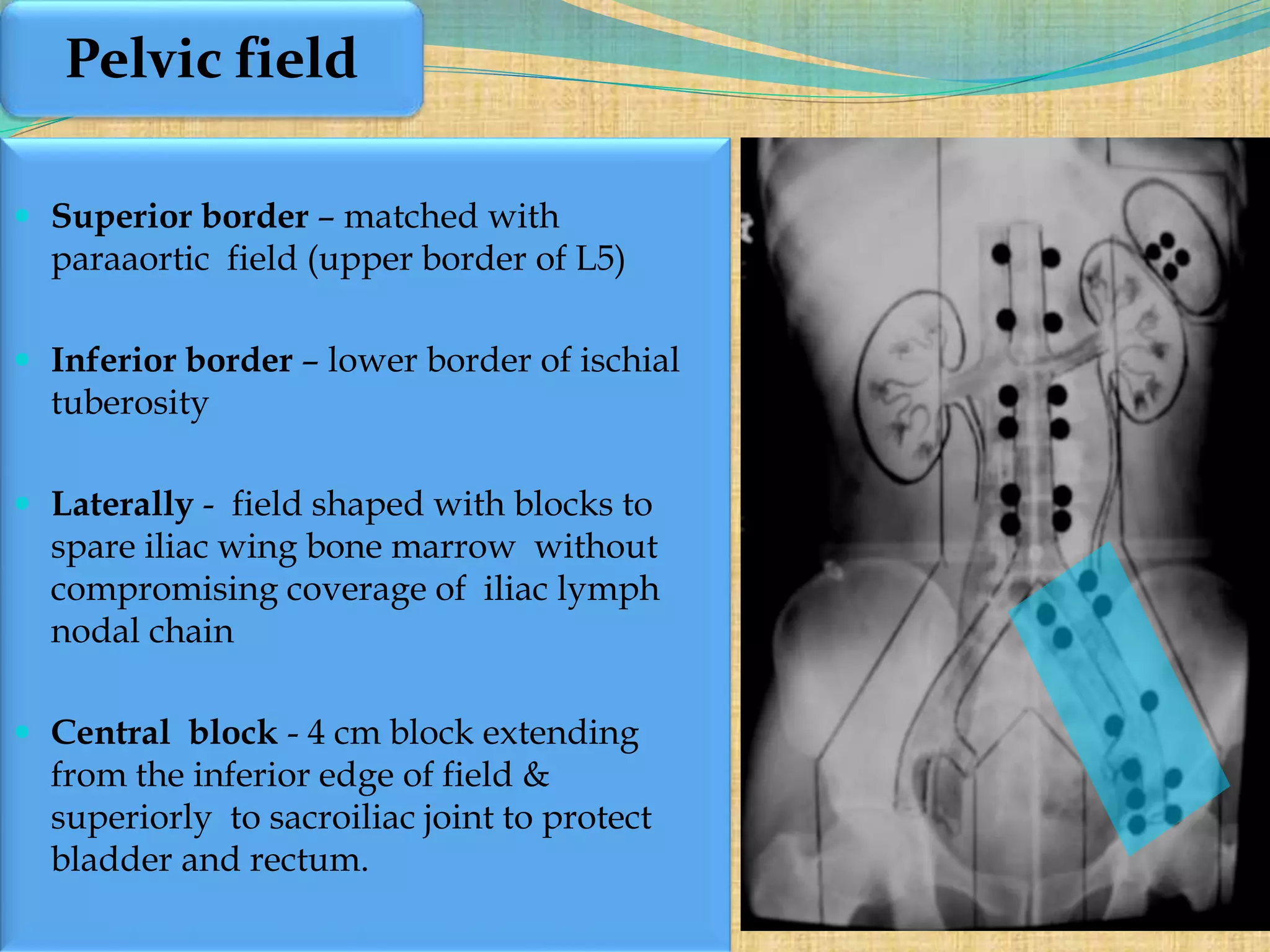 Hodgkin's lymphoma early stage management | PPTX