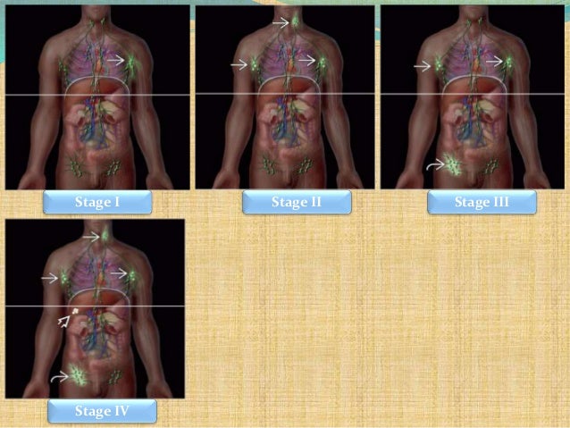 Hodgkin's lymphoma early stage management