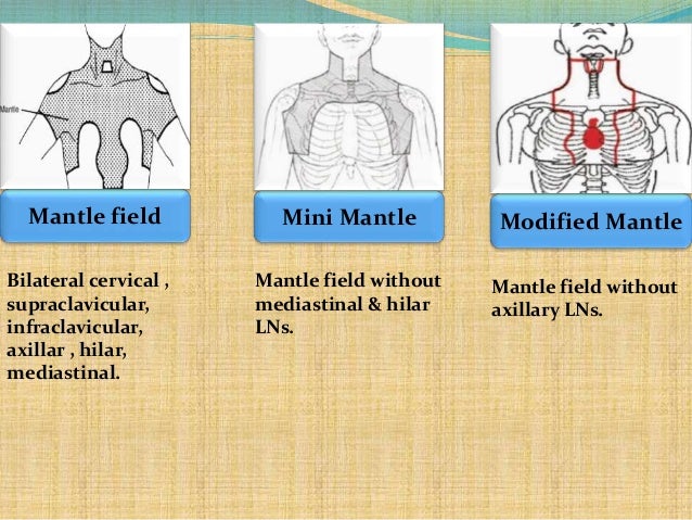 Hodgkin's lymphoma early stage management