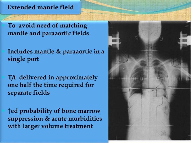 Hodgkin's lymphoma early stage management