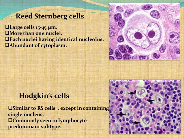 Hodgkin's lymphoma early stage management