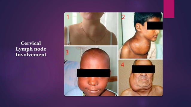 Hodgkins & Non-Hodgkins Lymphomas | PPTX | Cancer | Diseases and Conditions