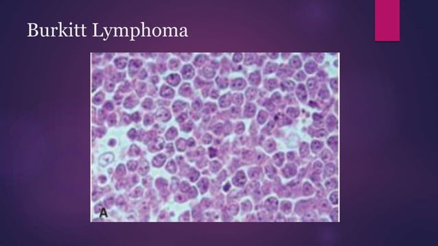 Hodgkins & Non-Hodgkins Lymphomas | PPTX | Cancer | Diseases and Conditions