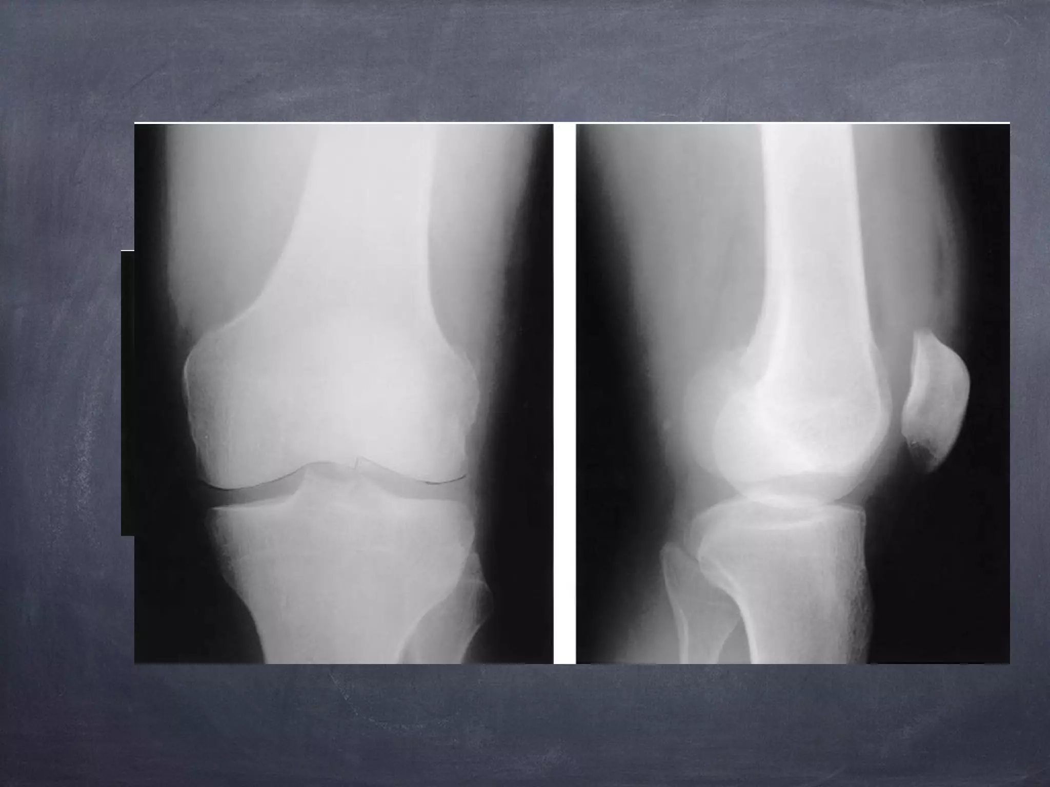 Hoffa's Fracture: Diagnosis, management & New Classification System by ...
