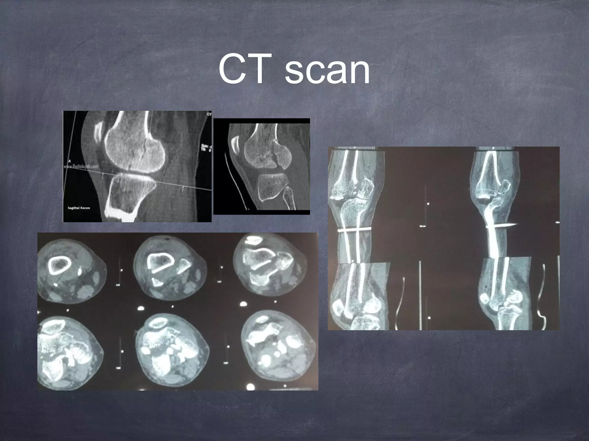 Hoffa's Fracture: Diagnosis, management & New Classification System by ...