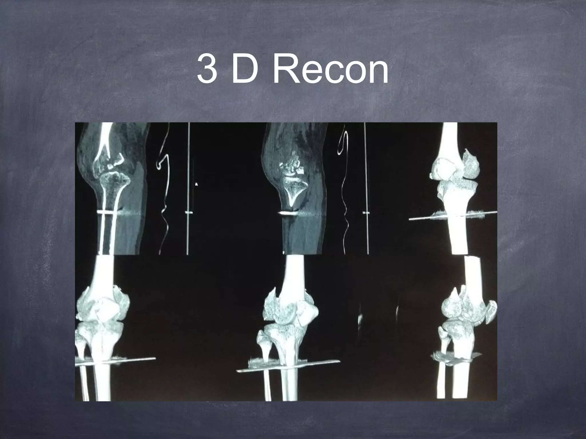 Hoffa's Fracture: Diagnosis, management & New Classification System by ...
