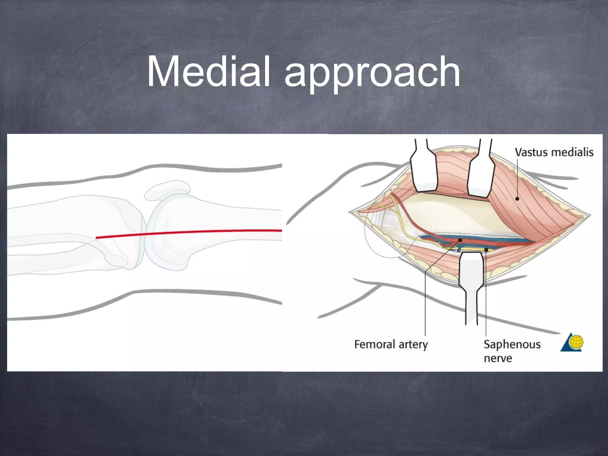 Hoffa's Fracture: Diagnosis, management & New Classification System by ...