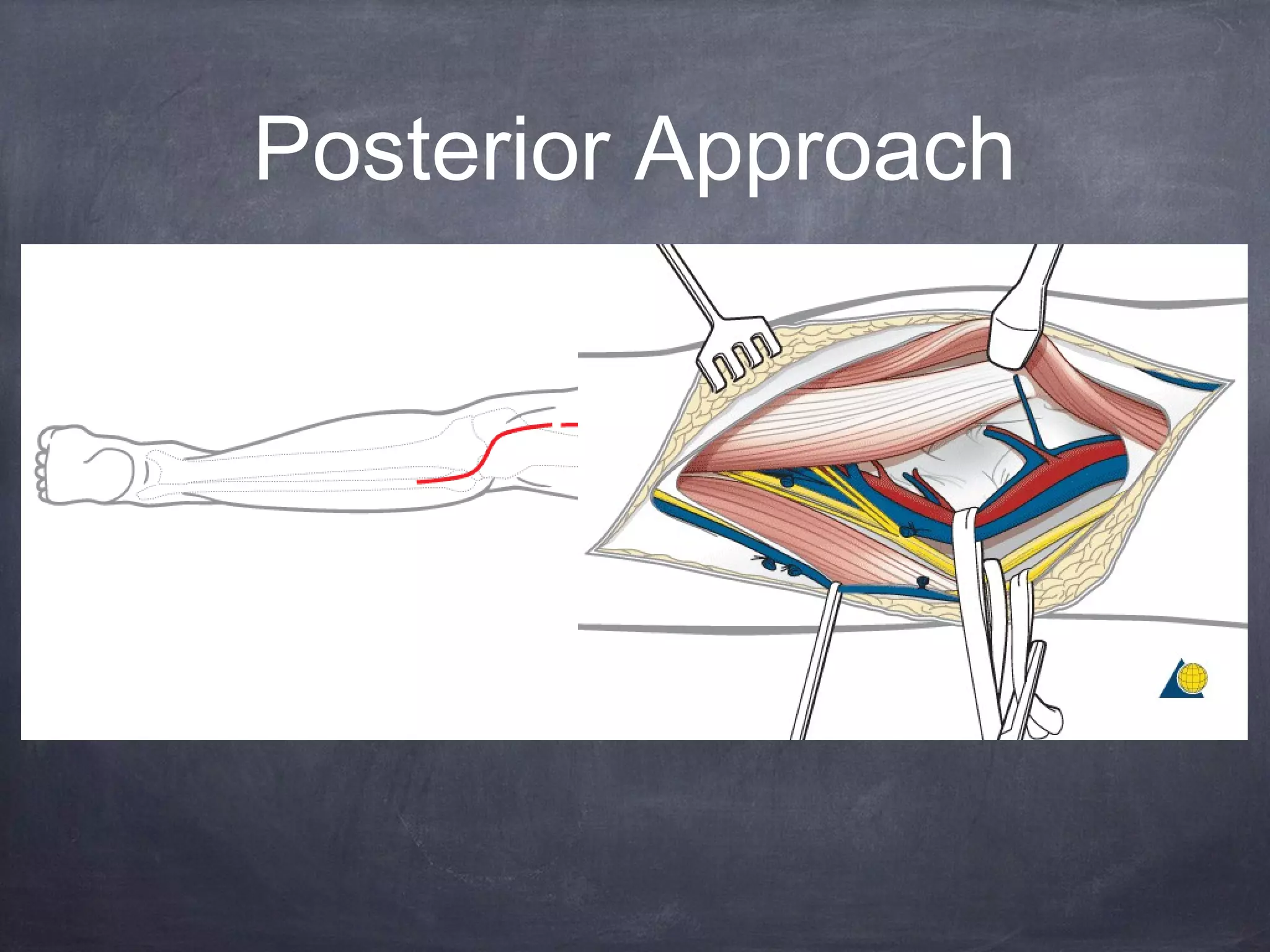 Hoffa's Fracture: Diagnosis, management & New Classification System by ...