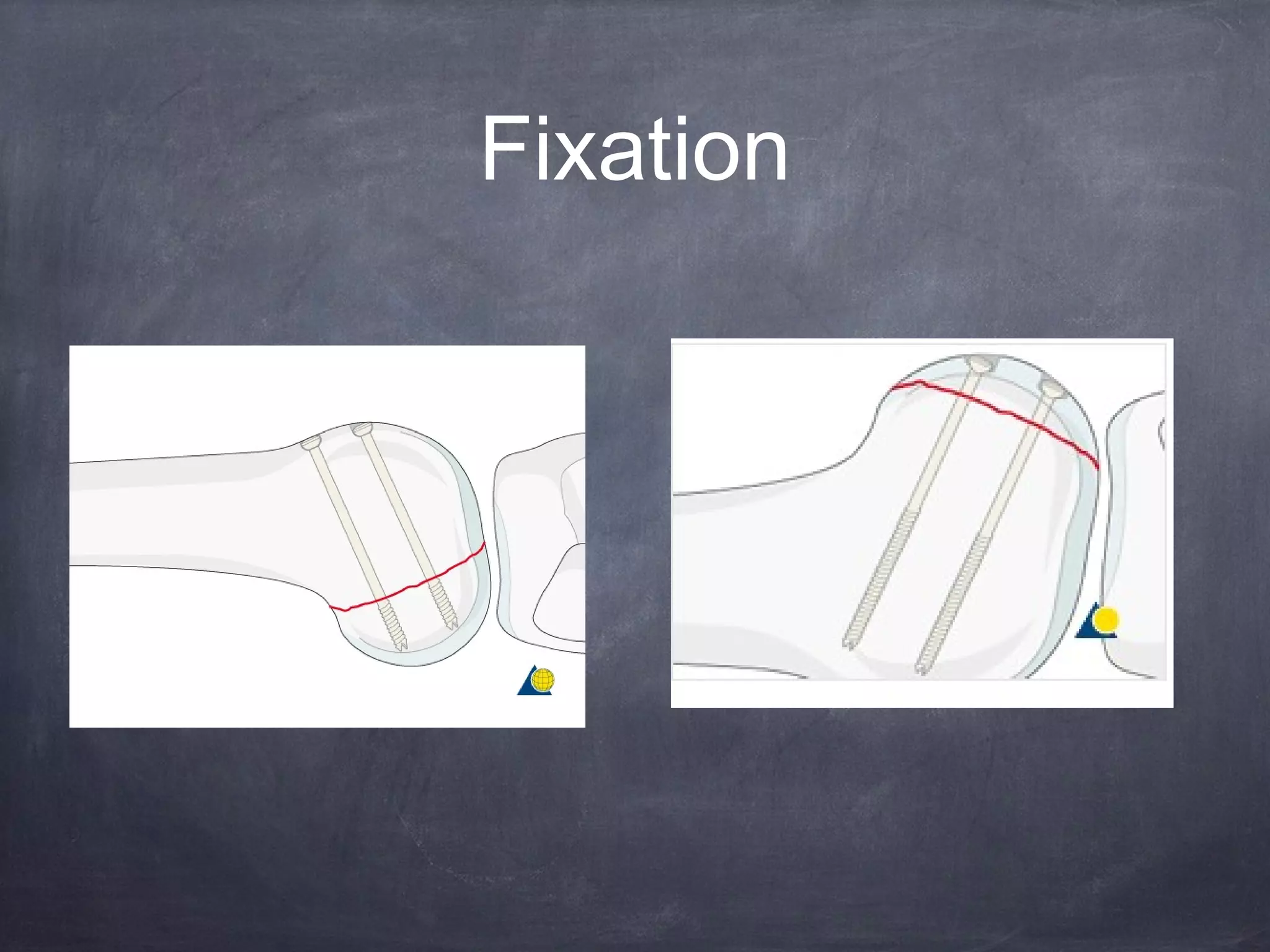 Hoffa's Fracture: Diagnosis, management & New Classification System by ...