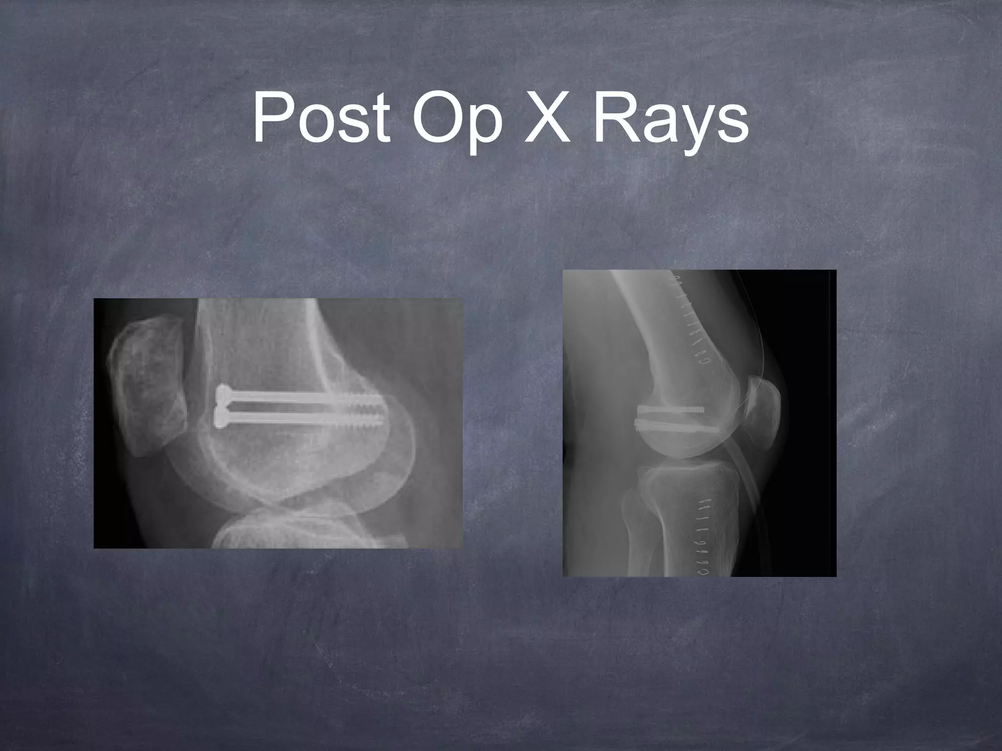 Hoffa's Fracture: Diagnosis, management & New Classification System by ...