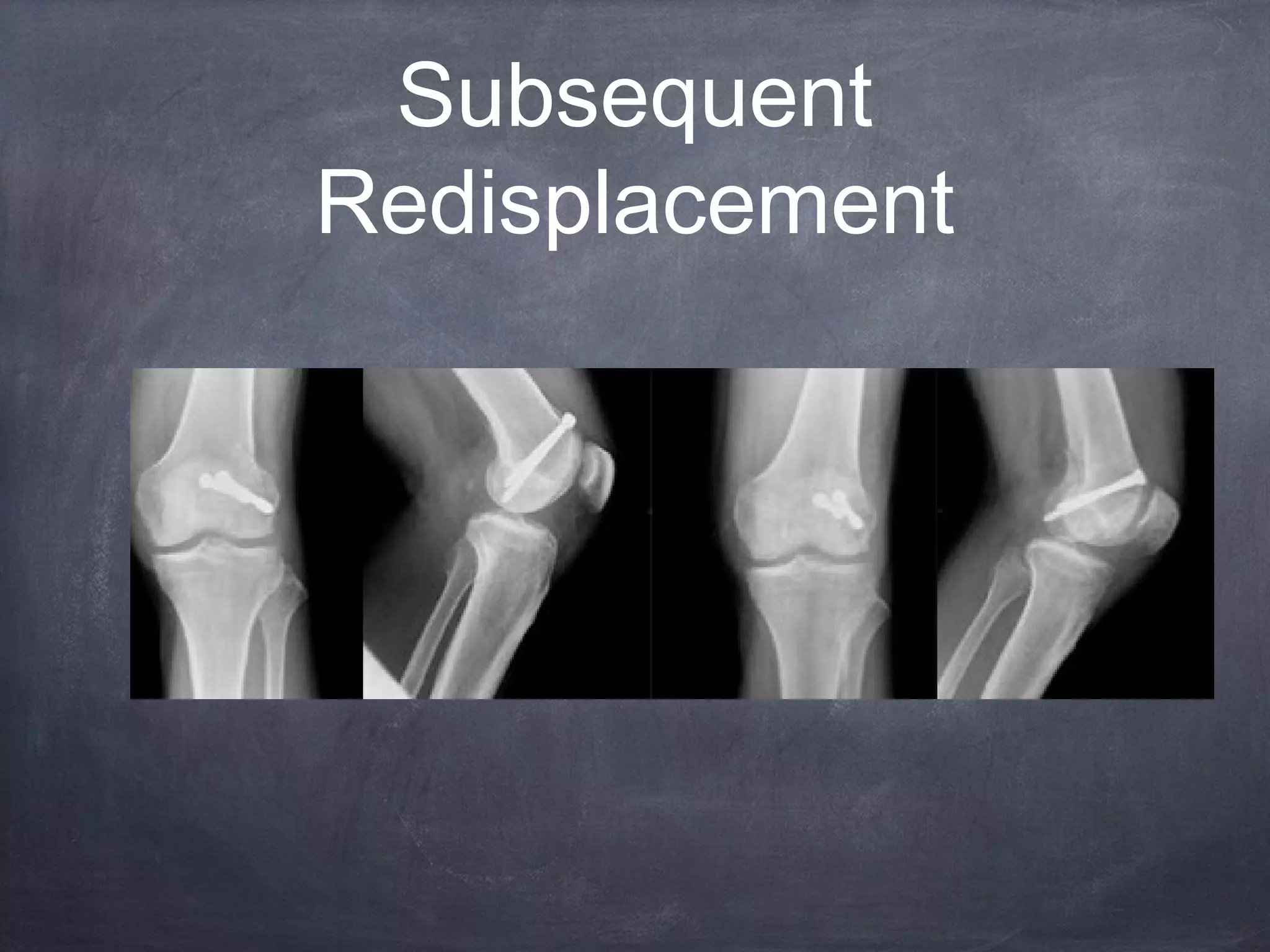 Hoffa's Fracture: Diagnosis, management & New Classification System by ...
