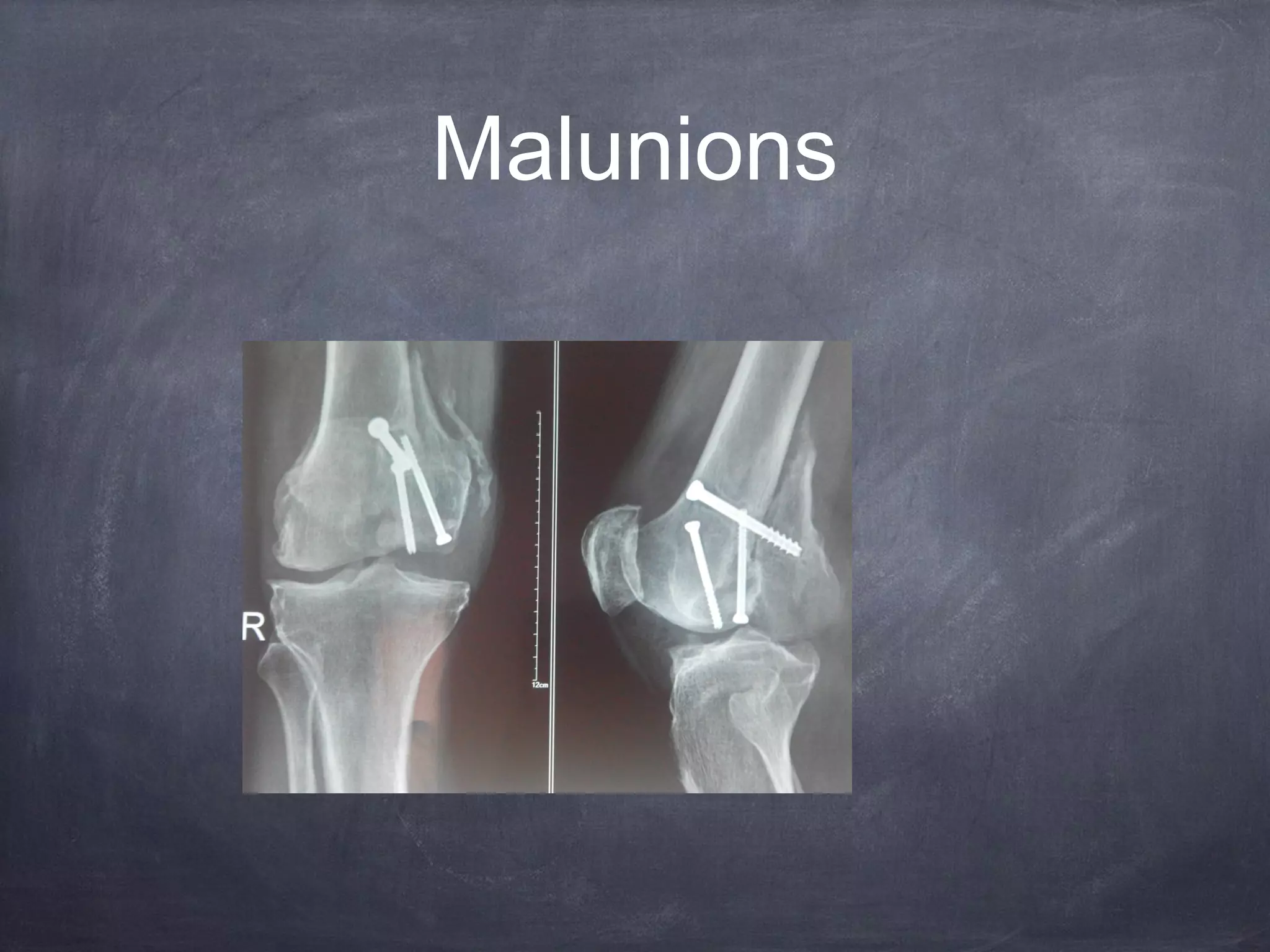 Hoffa's Fracture: Diagnosis, management & New Classification System by ...