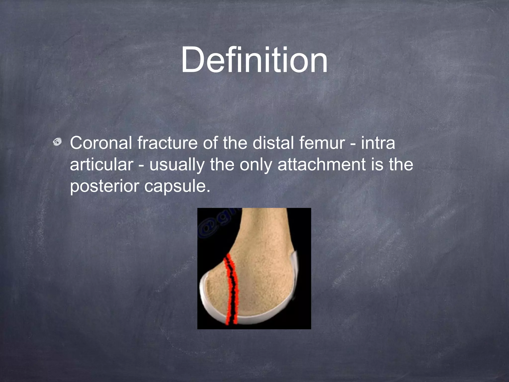 Hoffa's Fracture: Diagnosis, management & New Classification System by ...