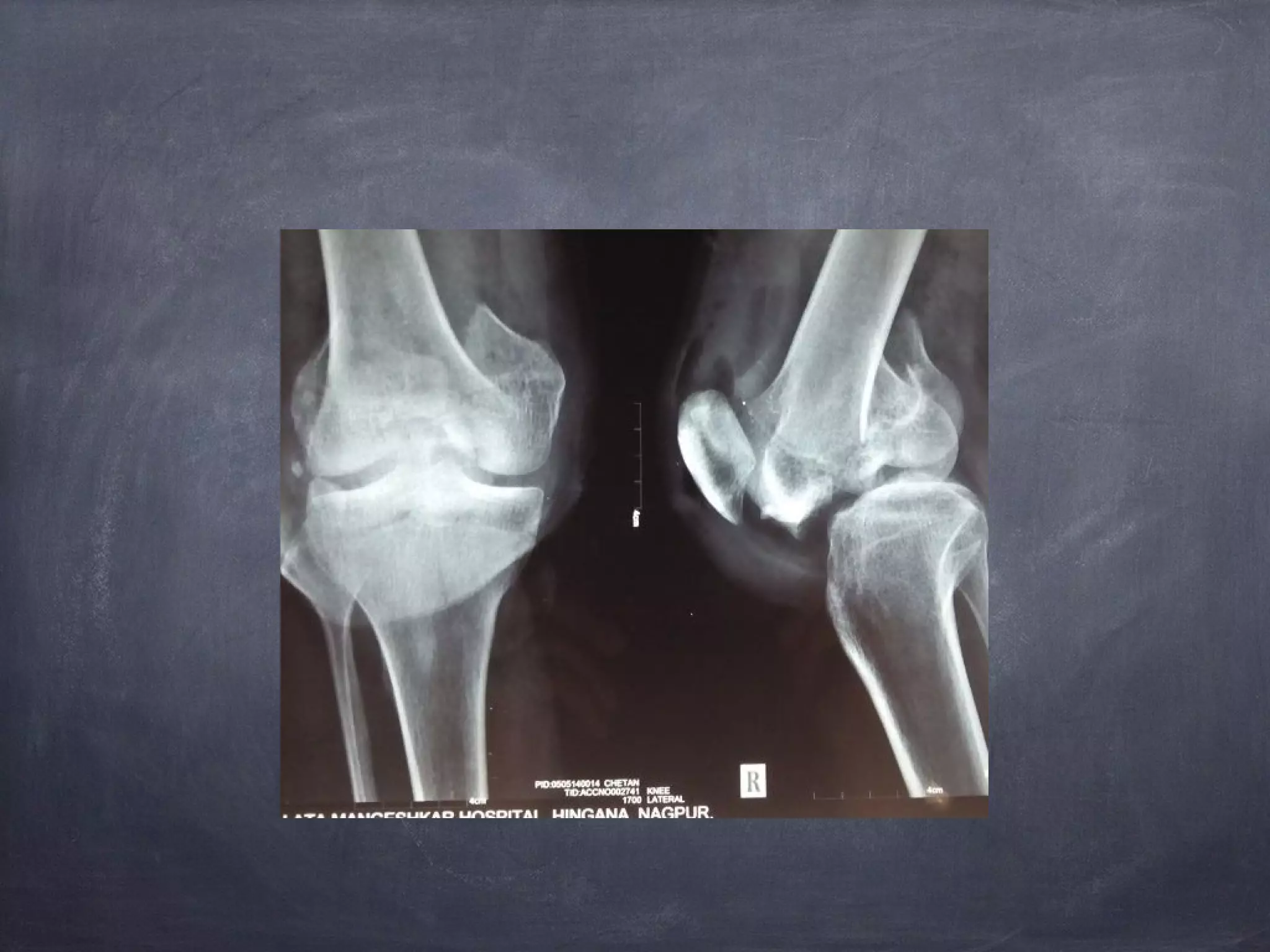 Hoffa's Fracture: Diagnosis, management & New Classification System by ...