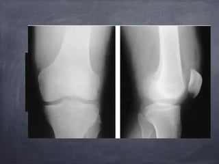 Hoffa's Fracture: Diagnosis, management & New Classification System by ...