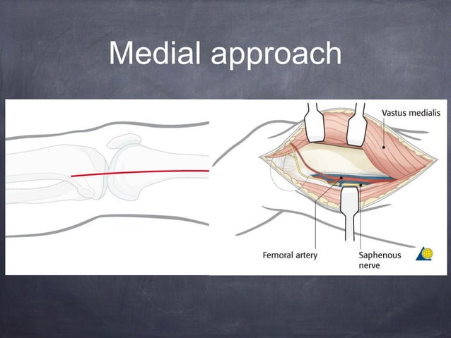 Hoffa's Fracture: Diagnosis, management & New Classification System by ...