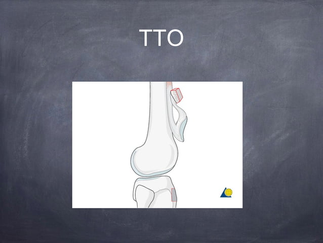Hoffa's Fracture: Diagnosis, management & New Classification System by ...