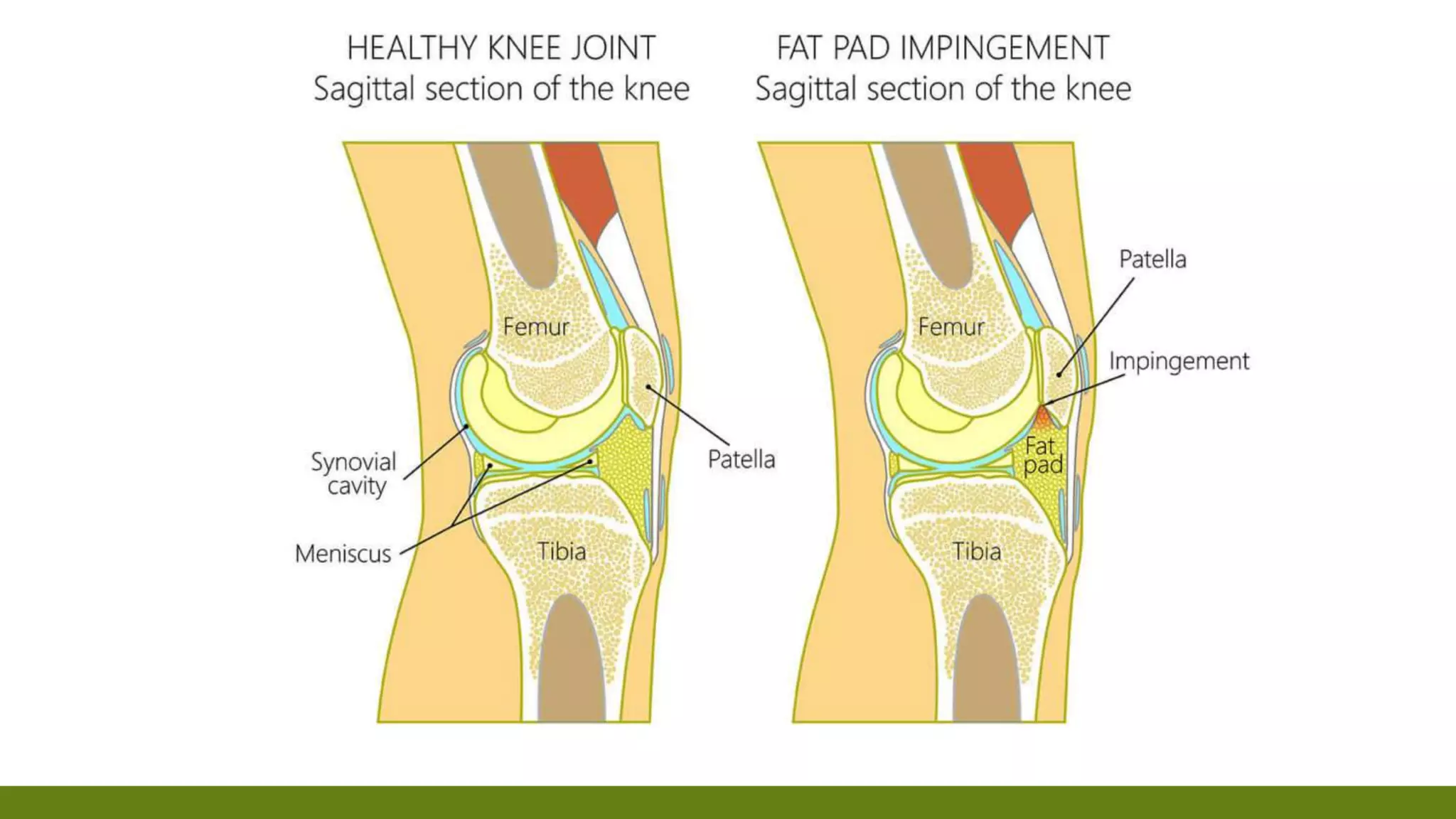 hoffas fat pad syndrome.pptx