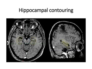 HOLISTIC APPROACH IN WHOLE BRAIN RADIATION IN BRAIN METS | PPTX