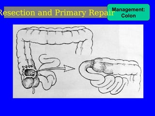 Hollow Viscus Injuries diagnosis & treatment | PPT