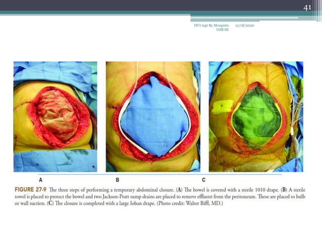 Hollow viscus injury management | PPTX | Death, Injury, or Military ...