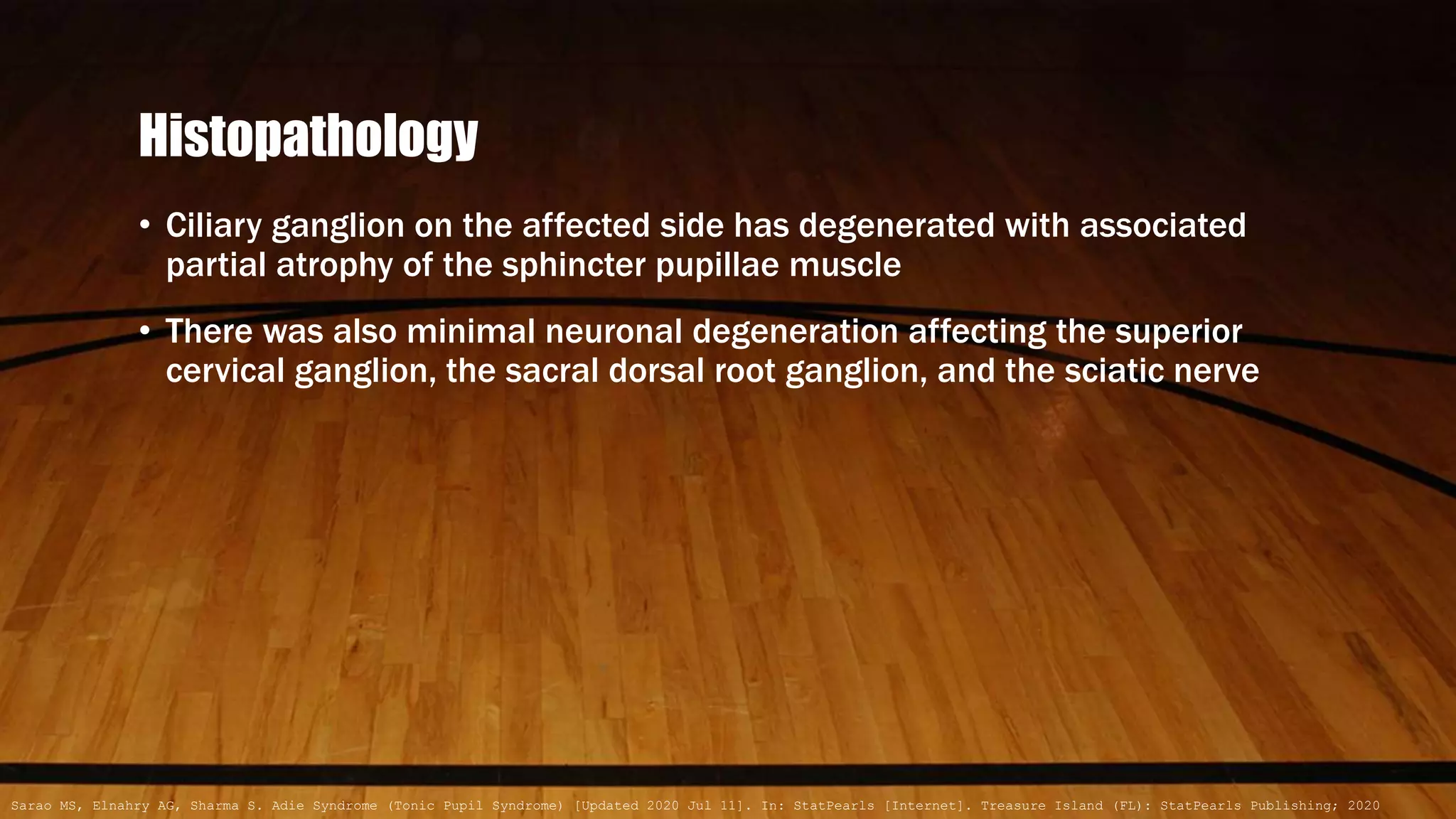 Holmes Adie Syndrome | PPTX