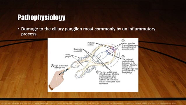 Holmes Adie Syndrome | PPTX | Eye and Vision Conditions | Diseases and ...