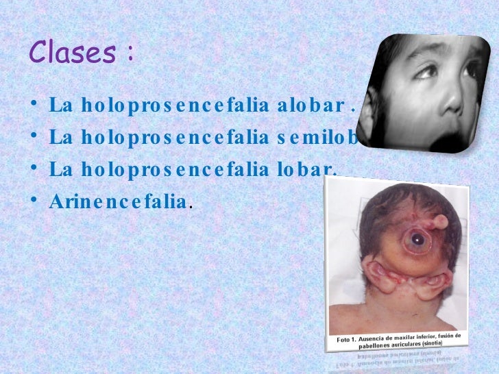 Holoprosencefalia Fernanda