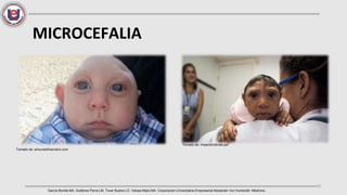 Holoprosencefalia y microcefalia | PPTX