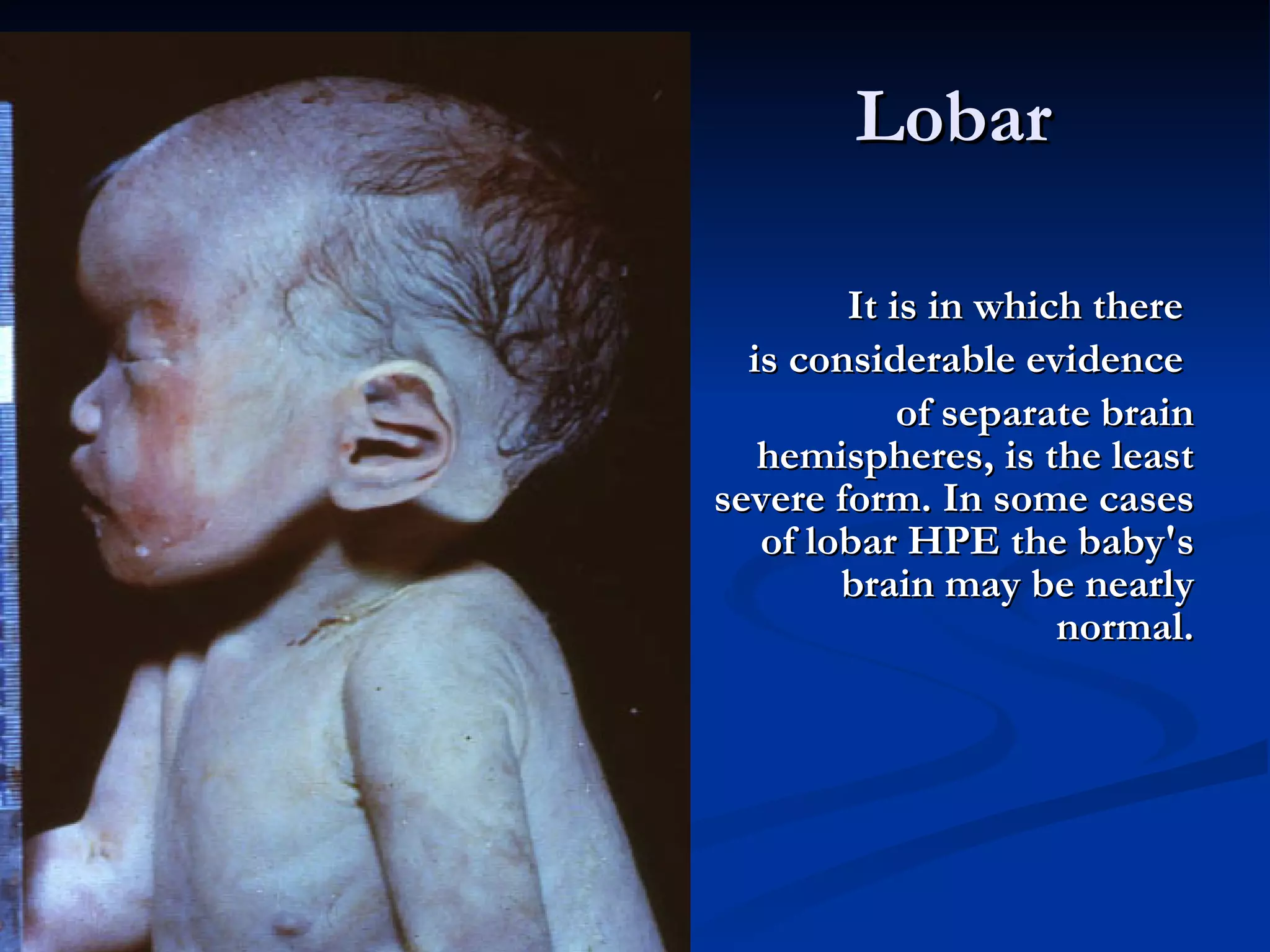 Holoprosencephaly | PPT